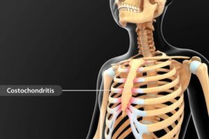 Costochondritis Physical Therapy Exercises Your Guide | BestHealthExpert