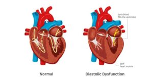 Grade 1 Diastolic Dysfunction Early Detection & Management ...