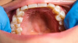How to Treat a Mouth Cut A Complete Guide | BestHealthExpert